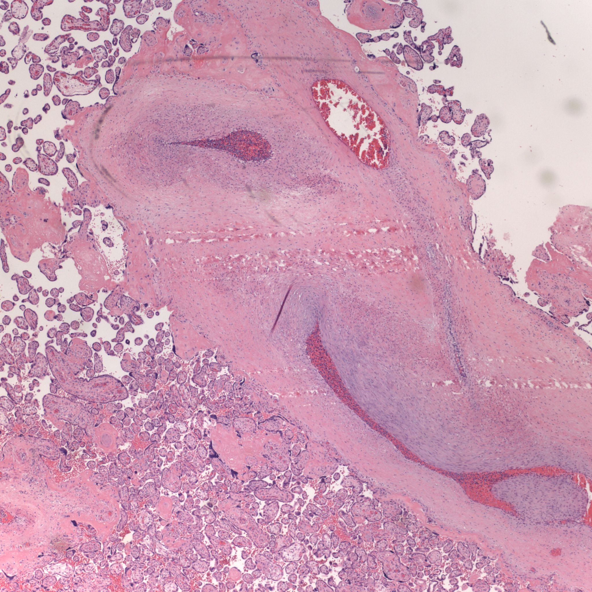 Looking at fetal blood in the placenta | obstetrical pathology