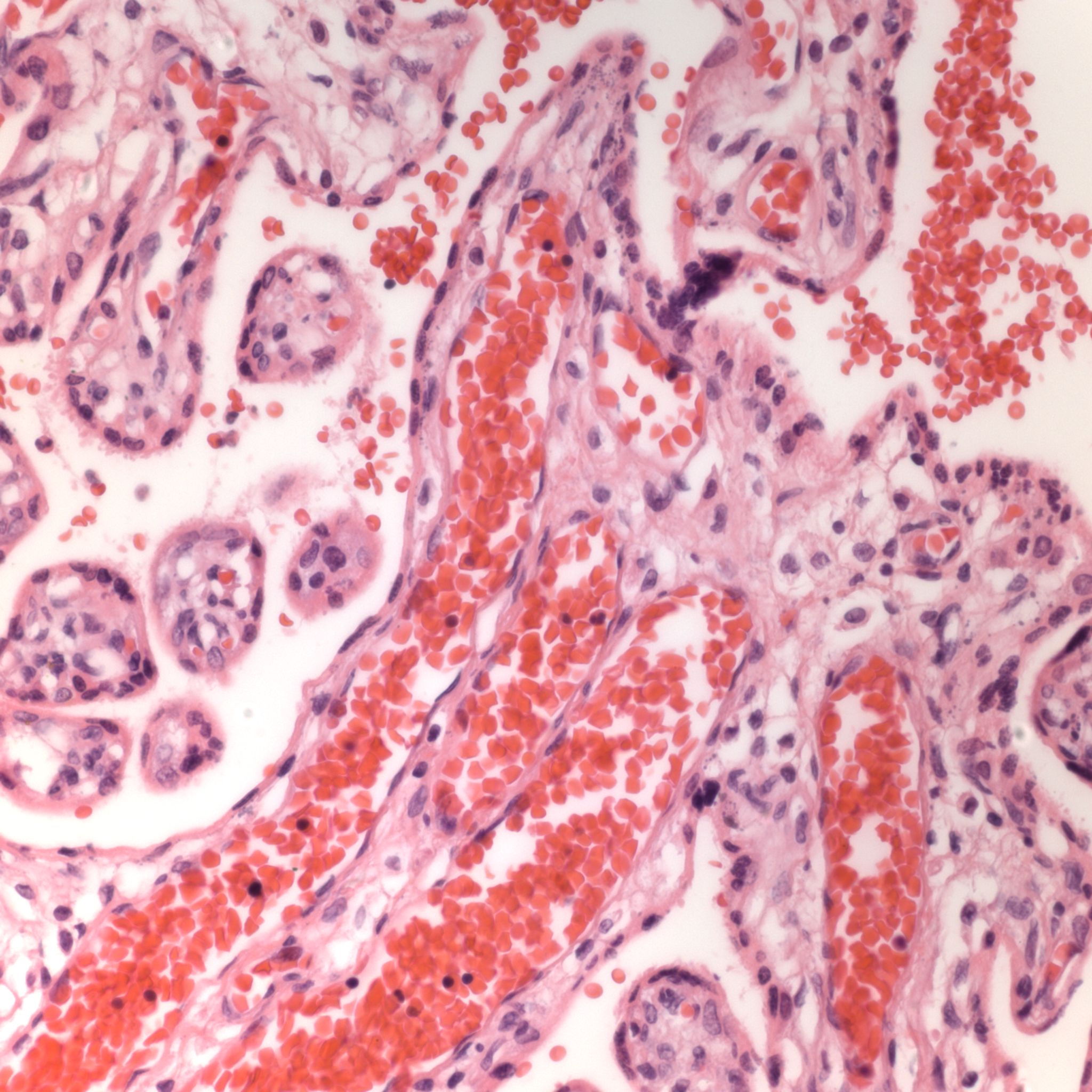 Looking at fetal blood in the placenta | obstetrical pathology