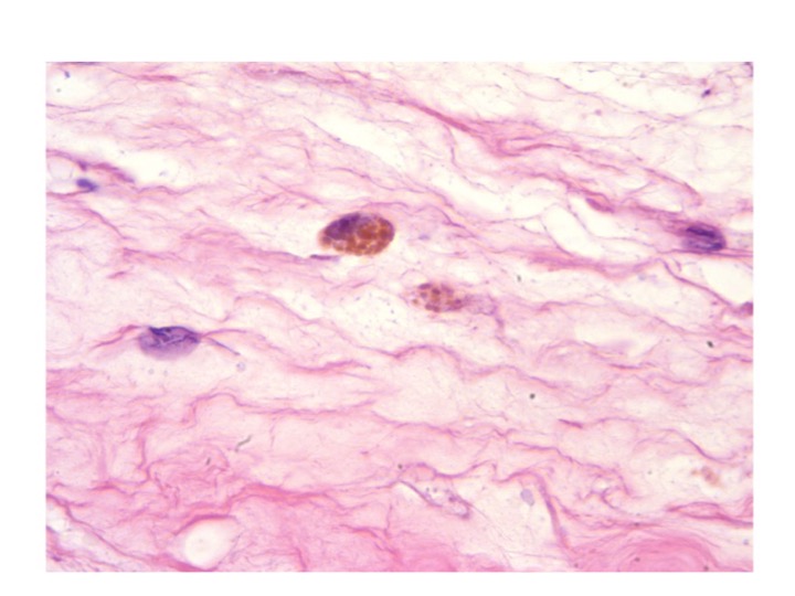 Chapter 6 Meconium | obstetrical pathology