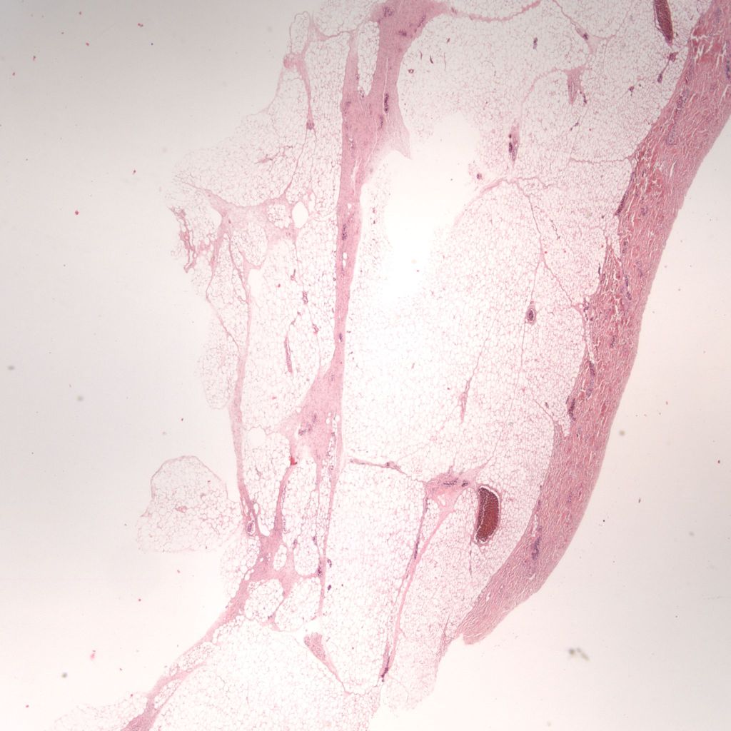 IDM case 5: Pulmonary congestion and hemorrhage | obstetrical pathology