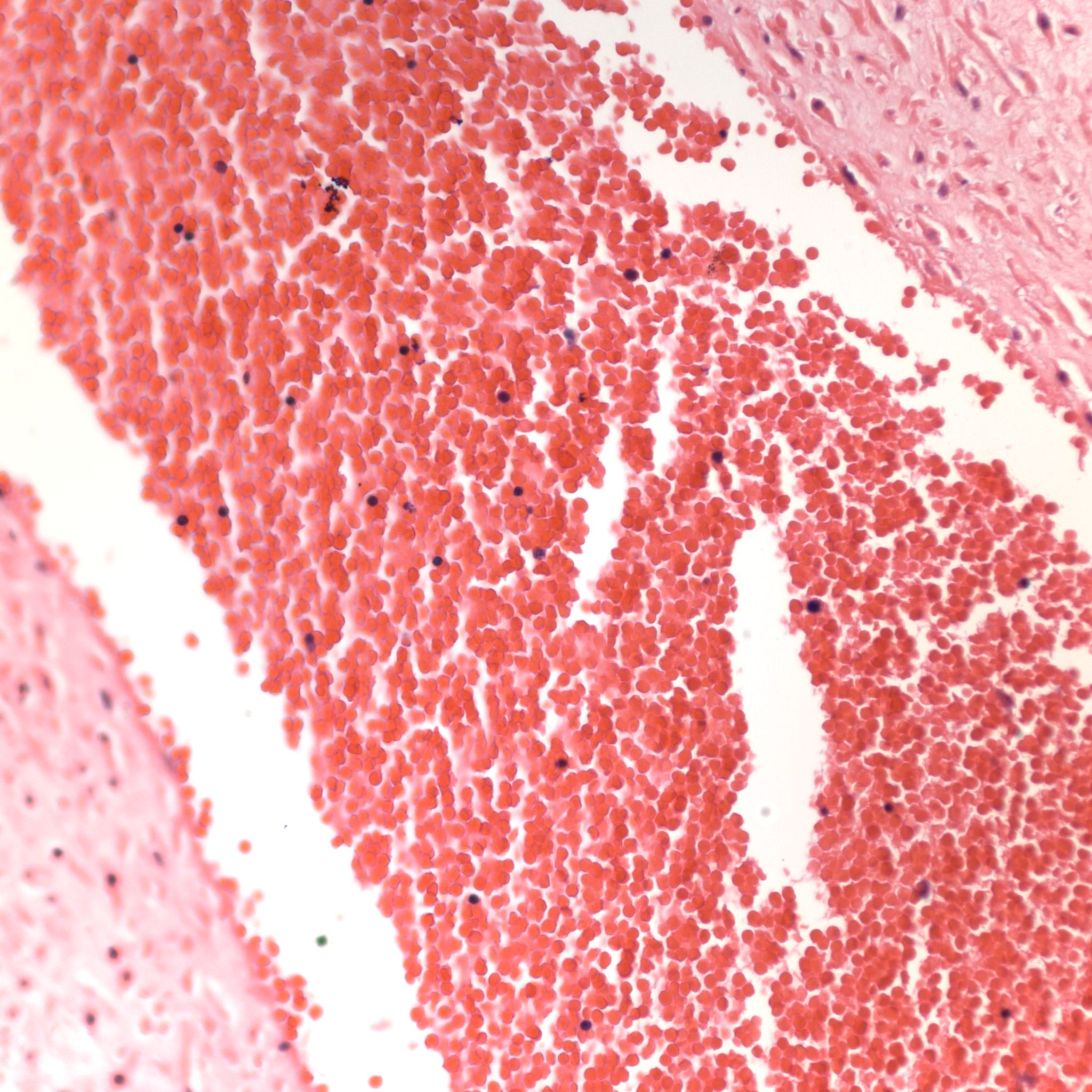 IDM case 2: cord wrapping, placental infarctions | obstetrical pathology
