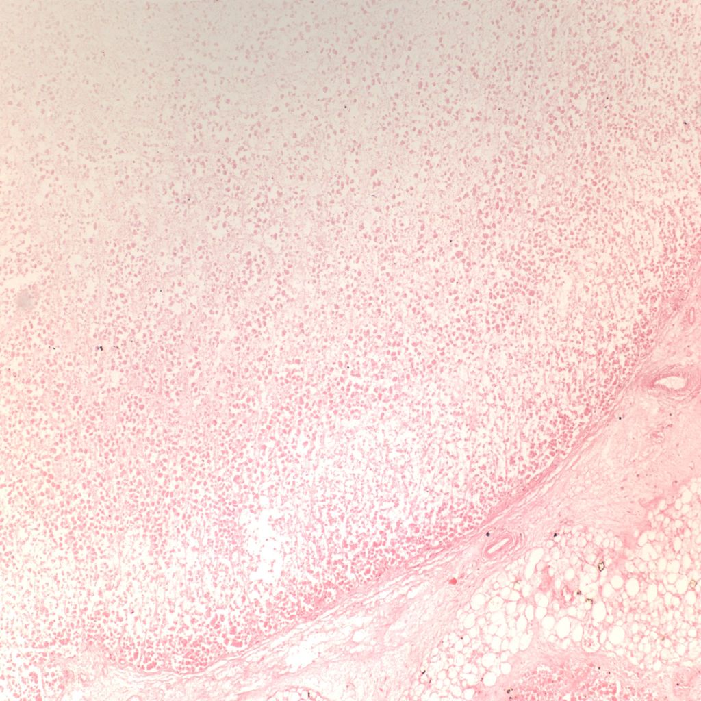 IDM case 5: Pulmonary congestion and hemorrhage | obstetrical pathology