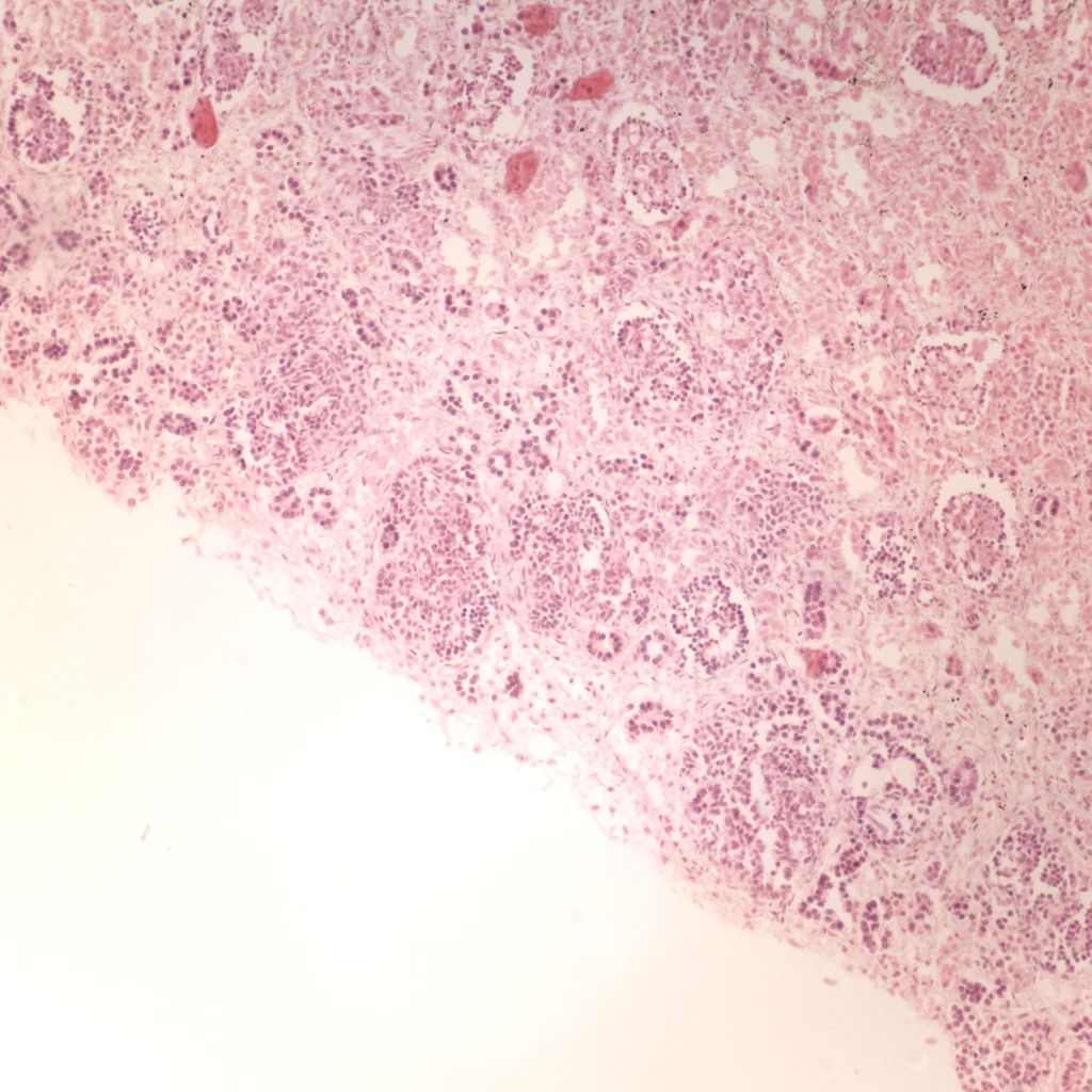 IDM case 5: Pulmonary congestion and hemorrhage | obstetrical pathology