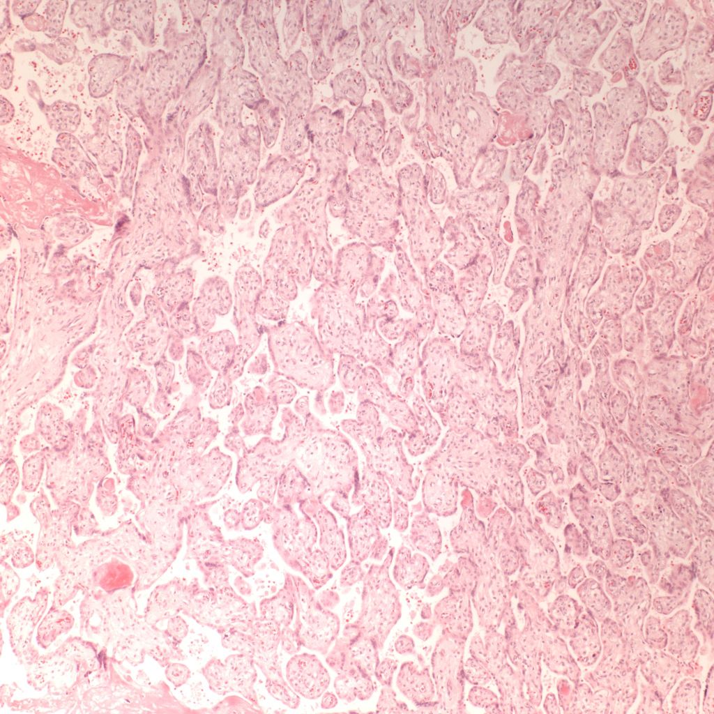 IDM case 5: Pulmonary congestion and hemorrhage | obstetrical pathology