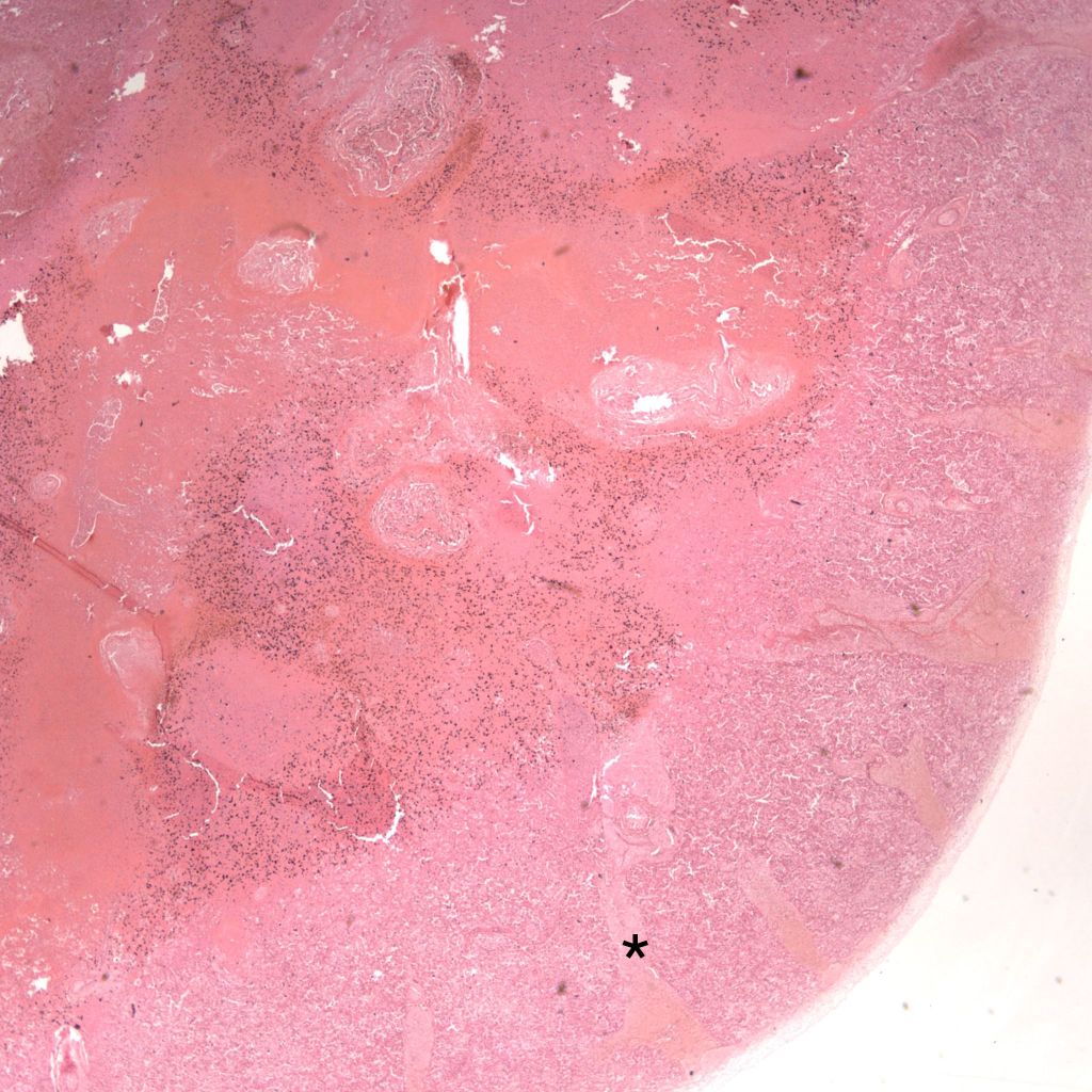 IDM case 5: Pulmonary congestion and hemorrhage | obstetrical pathology