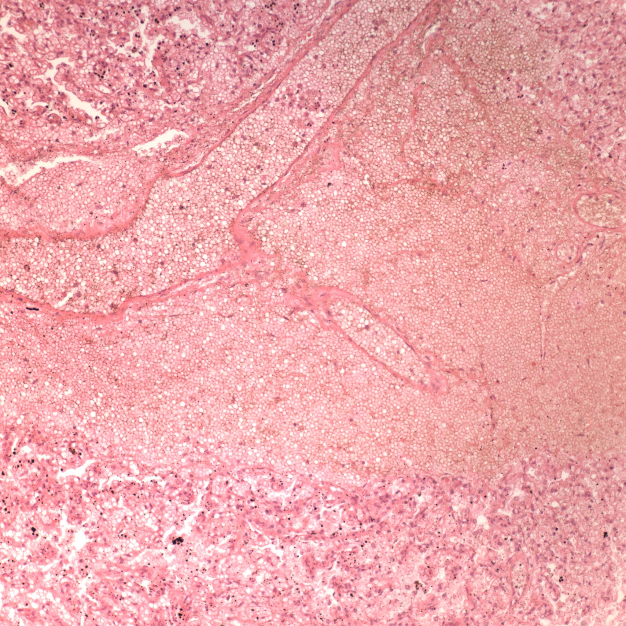 IDM case 5: Pulmonary congestion and hemorrhage | obstetrical pathology