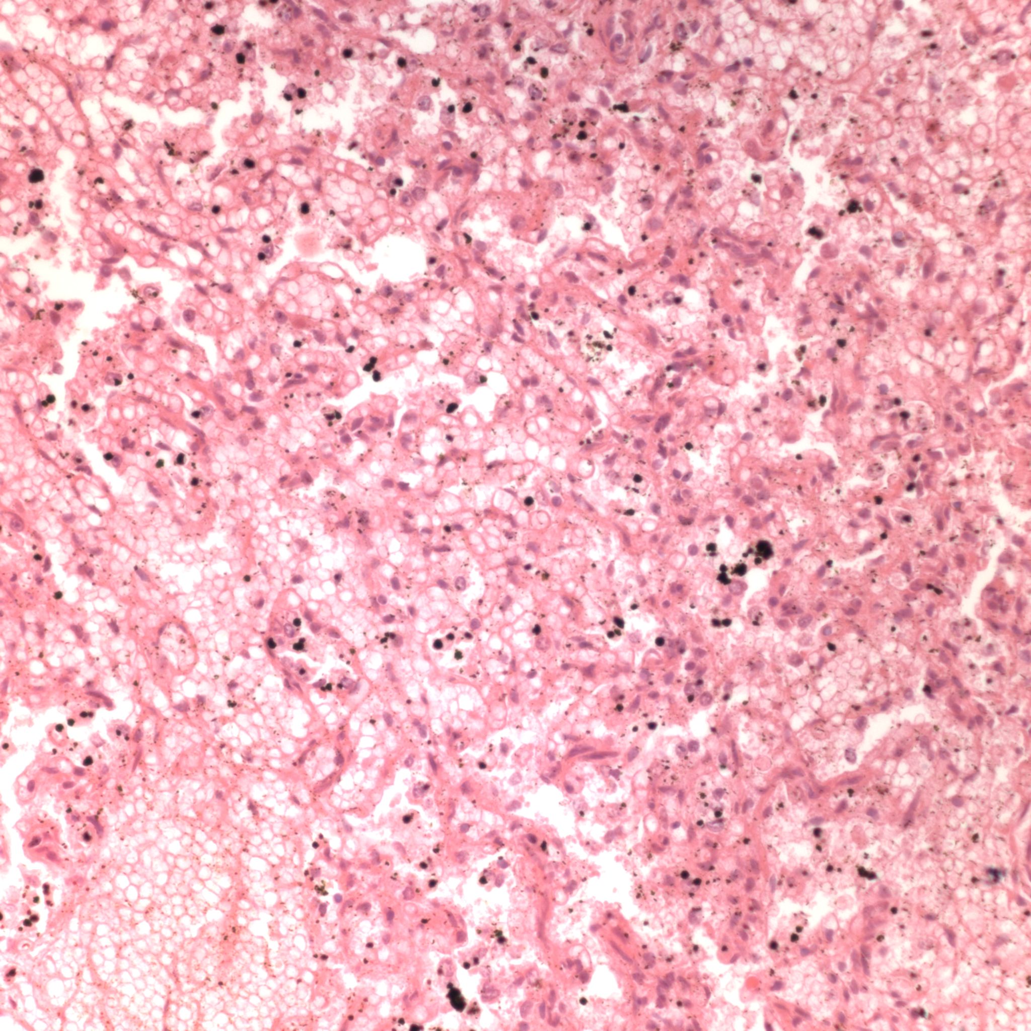 IDM case 5: Pulmonary congestion and hemorrhage | obstetrical pathology