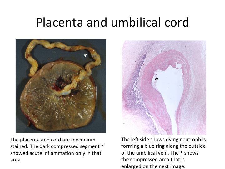 Chapter 2 supplement: Short Case Report #2: Umbilical Cord Compression ...
