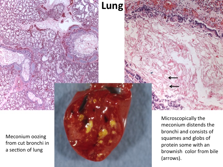 Chapter 2 supplement: Short Case Report #2: Umbilical Cord Compression ...