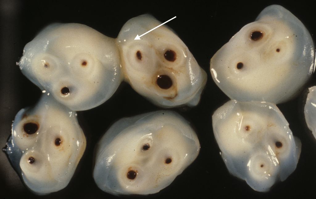 Chapter 13 Preterm Labor: Section C Subacute Necrotizing Funisitis (SNF ...