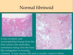 Chapter 10 Lesions of Villous Injury: Section B Maternal Floor ...