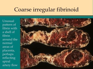 Chapter 10 Lesions of Villous Injury: Section B Maternal Floor ...