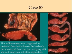 Chapter 10 Lesions of Villous Injury: Section B Maternal Floor ...