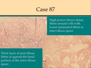 Chapter 10 Lesions of Villous Injury: Section B Maternal Floor ...