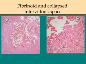 Chapter 10 Lesions of Villous Injury: Section B Maternal Floor ...