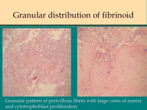 Chapter 10 Lesions of Villous Injury: Section B Maternal Floor ...