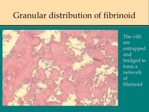 Chapter 10 Lesions of Villous Injury: Section B Maternal Floor ...