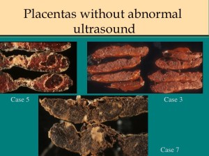 Chapter 10 Lesions of Villous Injury: Section B Maternal Floor ...