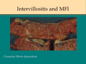 Chapter 10 Lesions of Villous Injury: Section B Maternal Floor ...