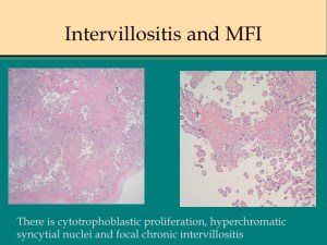 Chapter 10 Lesions of Villous Injury: Section B Maternal Floor ...