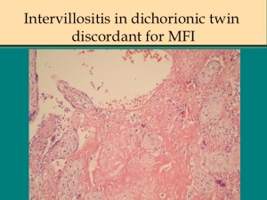 Chapter 10 Lesions of Villous Injury: Section B Maternal Floor ...