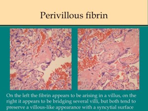 Chapter 10 Lesions of Villous Injury: Section B Maternal Floor ...
