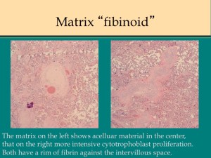 Chapter 10 Lesions of Villous Injury: Section B Maternal Floor ...