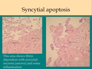 Chapter 10 Lesions of Villous Injury: Section B Maternal Floor ...