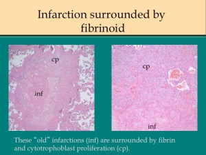 Chapter 10 Lesions of Villous Injury: Section B Maternal Floor ...