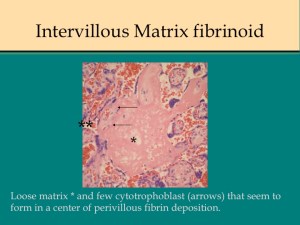 Chapter 10 Lesions of Villous Injury: Section B Maternal Floor ...