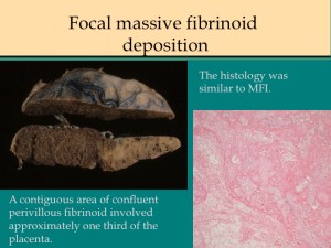 Chapter 10 Lesions of Villous Injury: Section B Maternal Floor ...