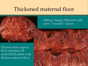 Chapter 10 Lesions of Villous Injury: Section B Maternal Floor ...