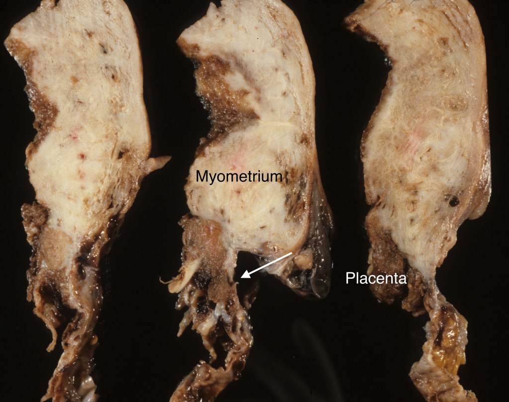 Chapter 4 Decidua: Section A Placenta Accreta | obstetrical pathology