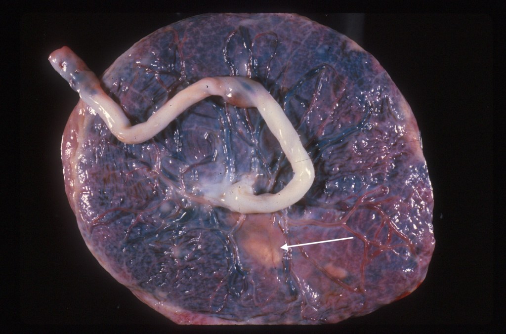 Chapter 4 Decidua: Section C Breus mole (Subchorionic thrombohematoma ...