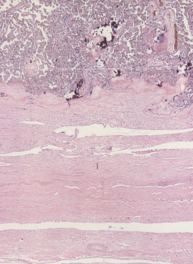 Chapter 4 Decidua: Section A Placenta Accreta | obstetrical pathology
