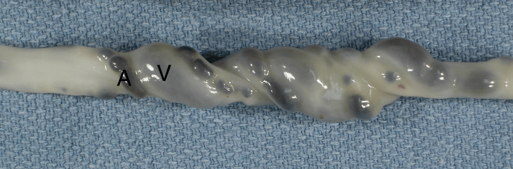 Chapter 2 Umbilical cord “accident”: Part 2 | obstetrical pathology