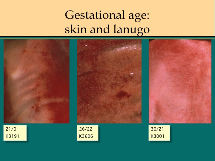 Autopsy Manual: Gestational Age | obstetrical pathology