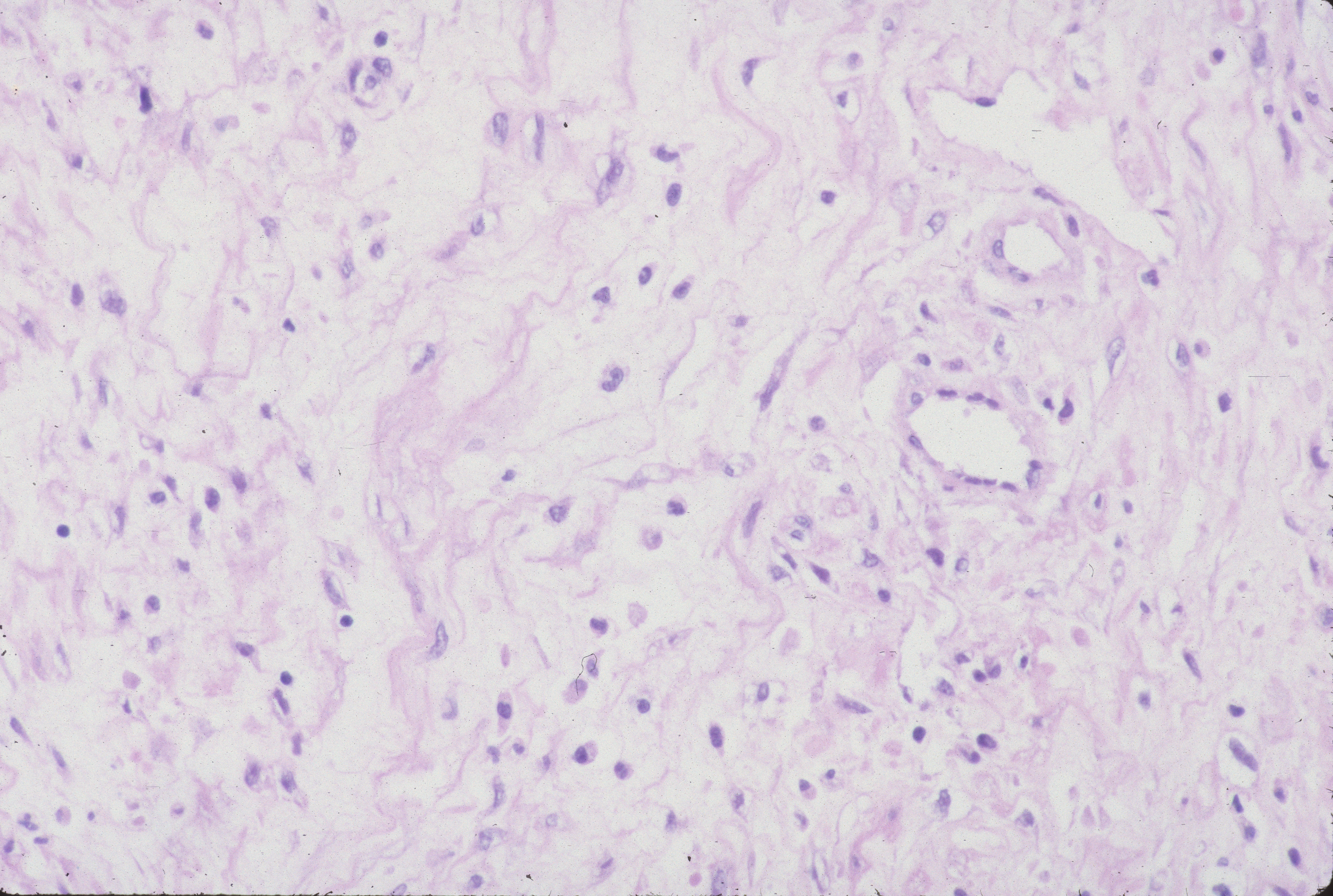 Chapter 13 Preterm Labor: Section A The Cervix | obstetrical pathology