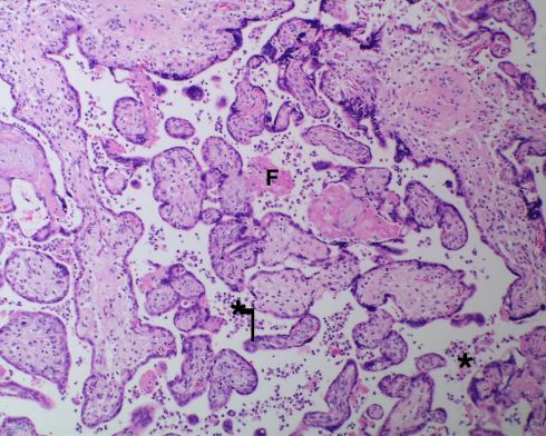 Chronic histiocytic intervillositis (CHIV) | obstetrical pathology