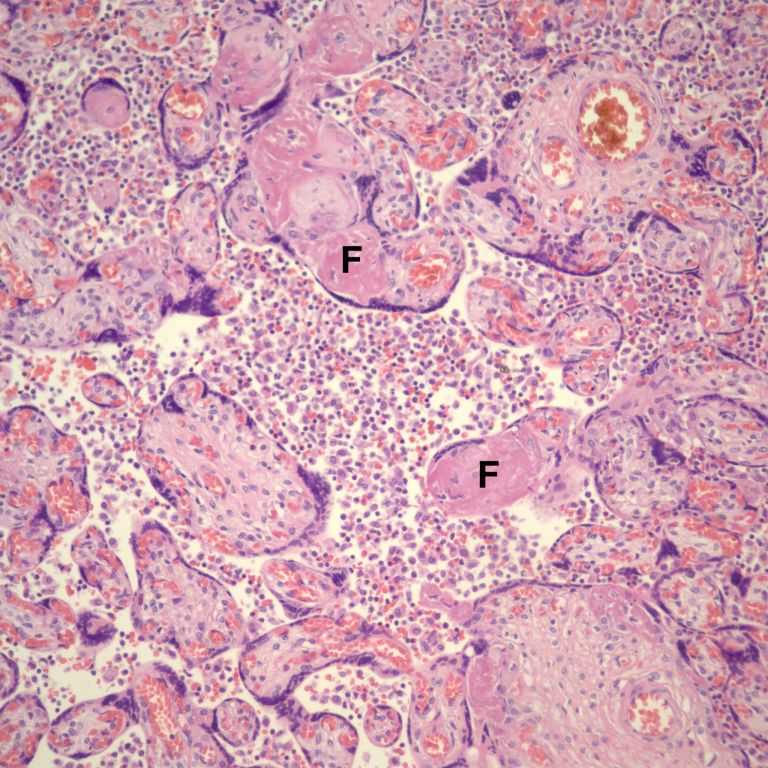 Chronic histiocytic intervillositis (CHIV) | obstetrical pathology