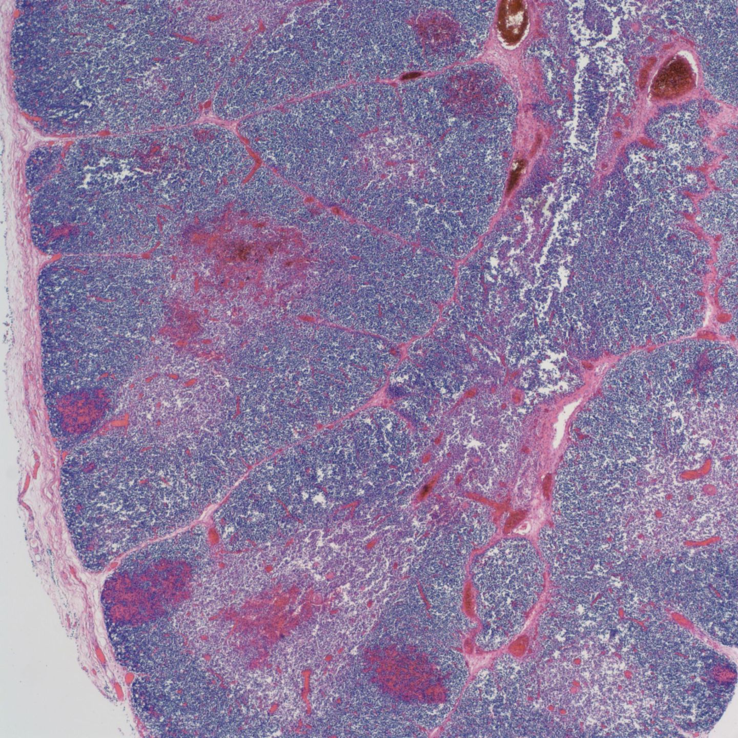 Autopsy Manual: Thymus | obstetrical pathology