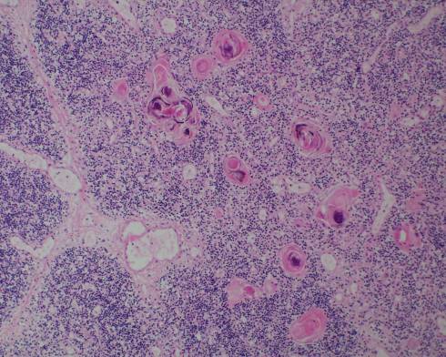 Autopsy Manual: Thymus | obstetrical pathology
