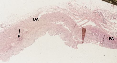 The Heart | obstetrical pathology