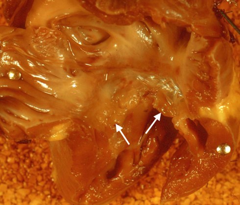 The Heart | obstetrical pathology