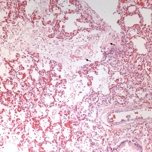 Autopsy Manual: Lung | obstetrical pathology