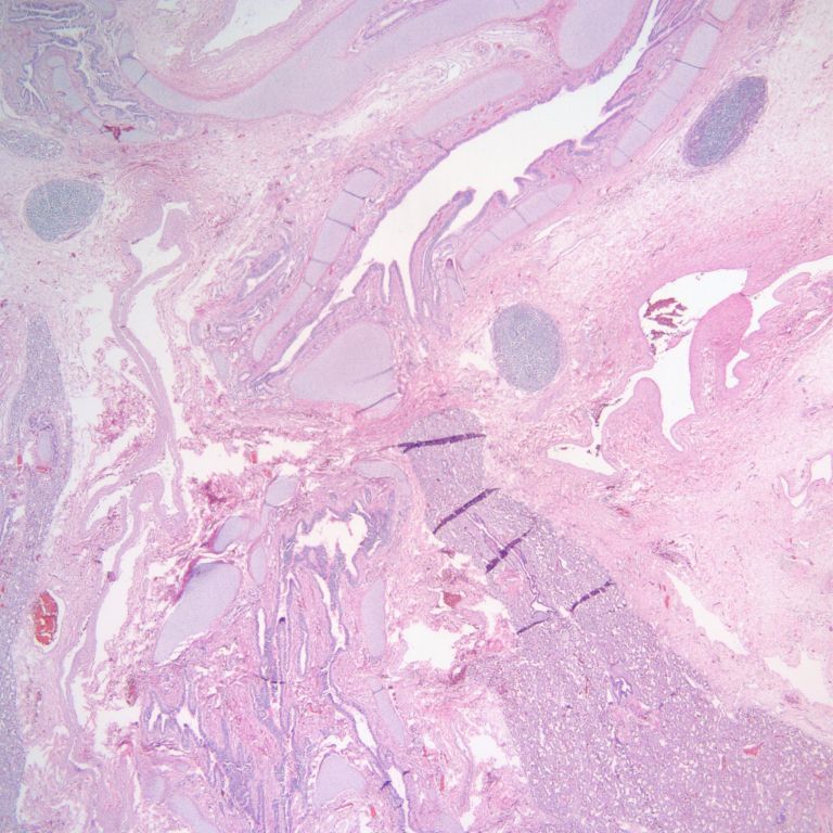 Autopsy Manual: Lung | obstetrical pathology