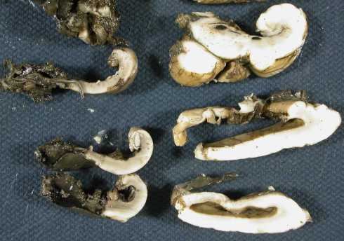 Autopsy Manual: Brain | obstetrical pathology