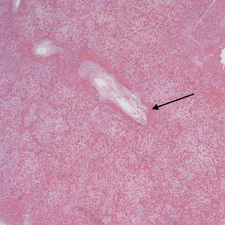 Autopsy Manual: Liver | obstetrical pathology