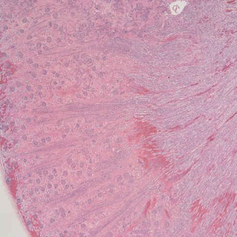 Kidney: Autopsy Manual | obstetrical pathology