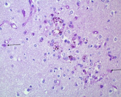 Autopsy Manual: Brain | obstetrical pathology